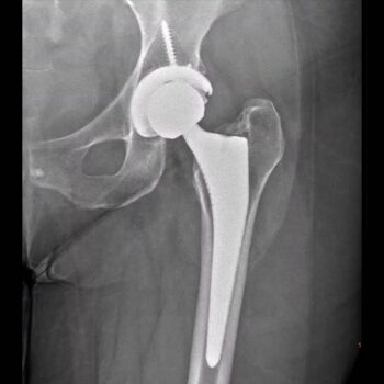 Anterior Hip Replacement in Modesto, CA - Dr. Eric Giang