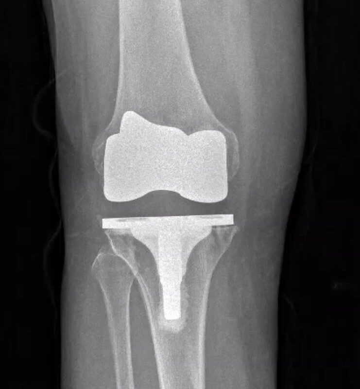 Robotic Knee Replacement Dr Eric Giang Modesto CA Robotic Knee Replacement Dr Eric Giang Modesto CA