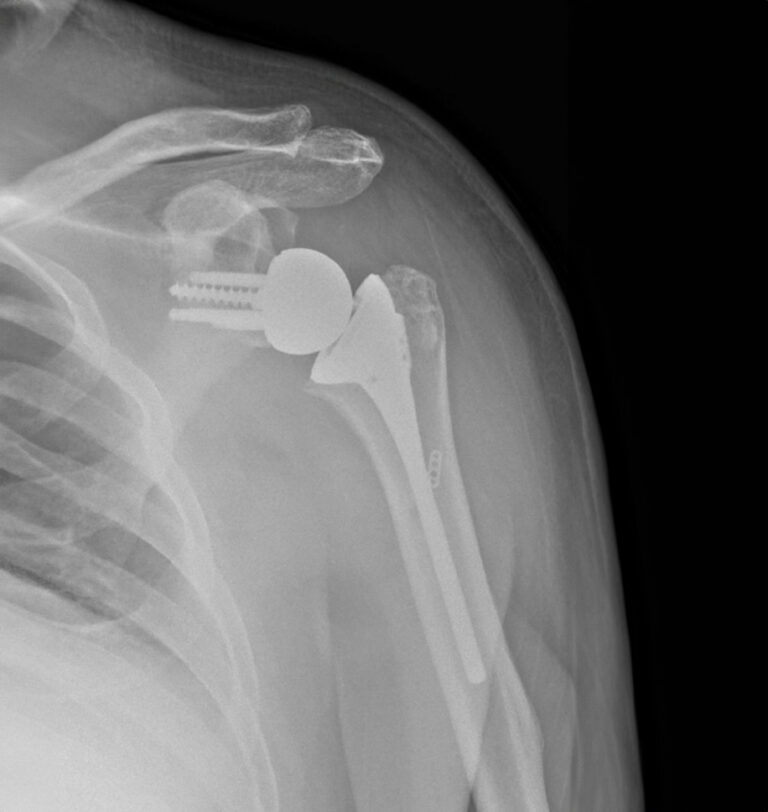 What Happens to Rotator Cuff Muscles After Reverse Shoulder Replacement ...