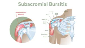 Understanding Subacromial Bursitis - Dr. Eric Giang